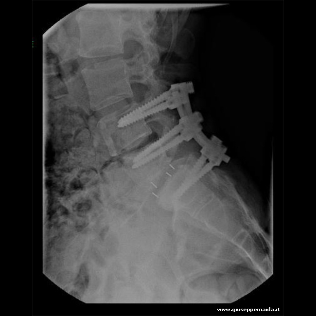 Lumbar and lumbosacral spondylolisthesis