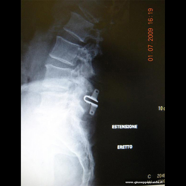 Stabilizzazione lombare dinamica interspinosa/interlaminare miniinvasiva