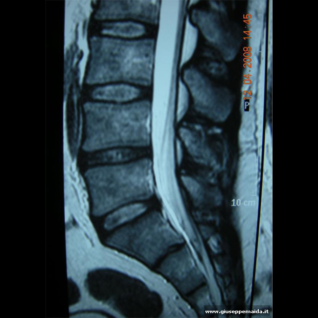 Stabilizzazione lombare dinamica interspinosa/interlaminare miniinvasiva