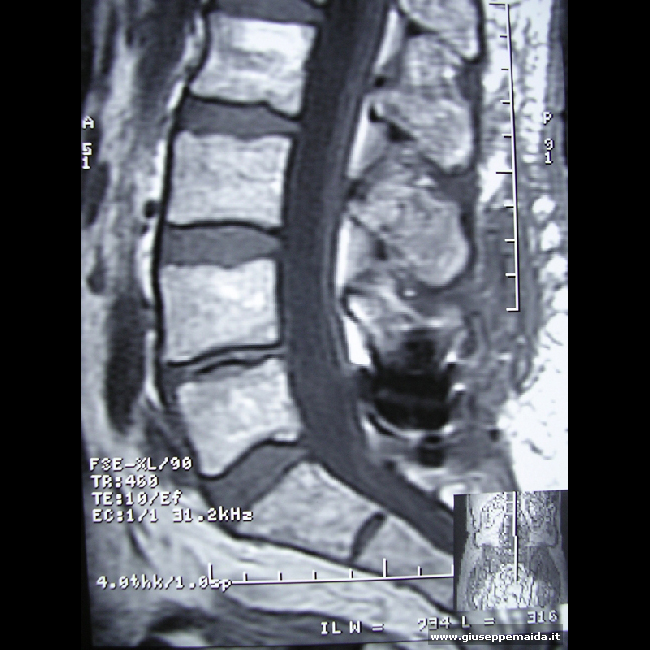 Stabilizzazione lombare dinamica interspinosa/interlaminare miniinvasiva