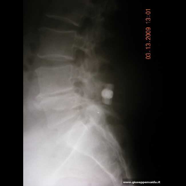 Stabilizzazione lombare dinamica interspinosa/interlaminare miniinvasiva