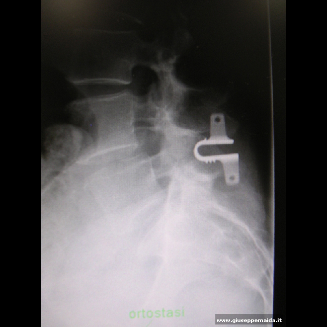 Stabilizzazione lombare dinamica interspinosa/interlaminare miniinvasiva