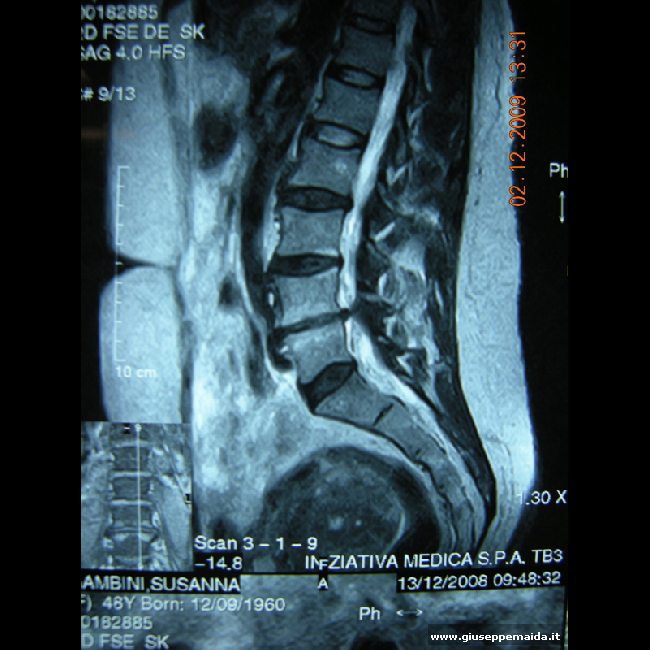 Stabilizzazione lombare dinamica interspinosa/interlaminare miniinvasiva