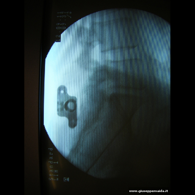 Stabilizzazione rigida interspinosa/interlaminare, lombare/lombosacrale ...