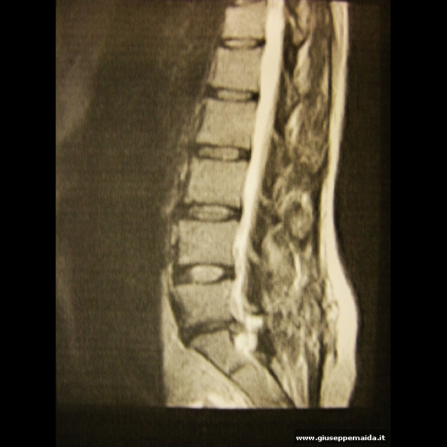 Stabilizzazione rigida interspinosa/interlaminare, lombare/lombosacrale ...