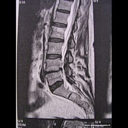 Stabilizzazione lombare dinamica interspinosa/interlaminare miniinvasiva